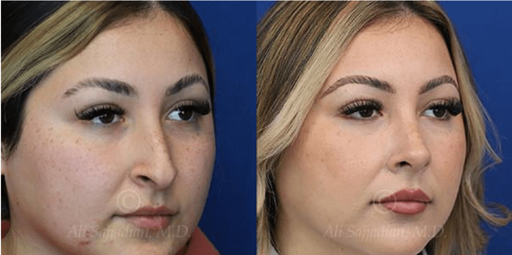 What is Hispanic Rhinoplasty? | Newport Beach | Dr. Ali Sajjadian