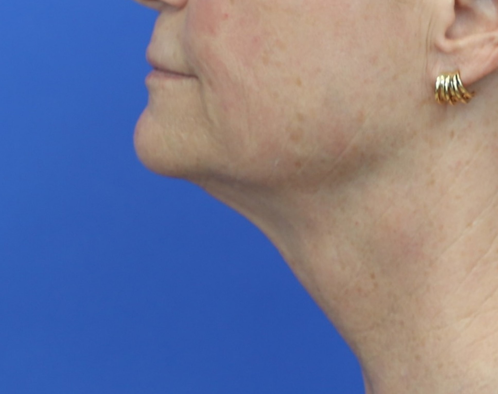 Profound RF Newport Beach & Orange County | Dr. Sajjadian